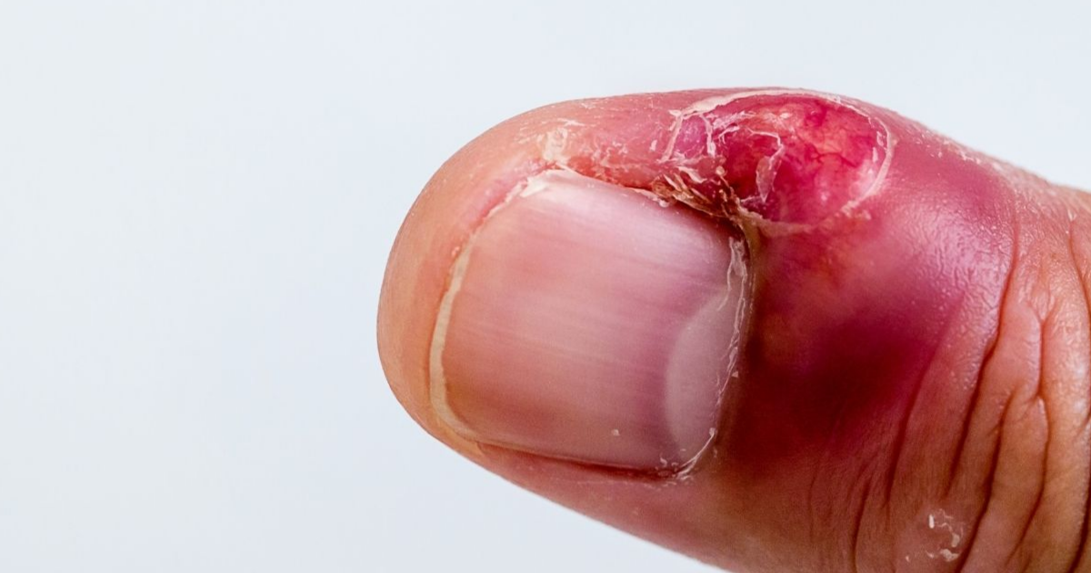 Unhas Inflamadas: Causa, Tratamento e Prevenção | UnhasEsmaltes